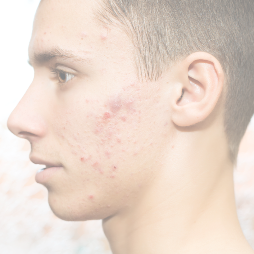 ¿Es acné o dermatitis? Conoce la solución aquí - Thanaka Blog